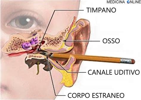 Corpo Estraneo Incastrato Nellorecchio Cosa Fare Come Toglierlo