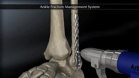 Arthrex Ankle Fracture Management System