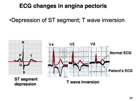 Chest Pain Angina Nstemi Stemi Flashcards Quizlet