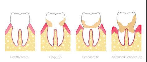 Enfermedad periodontal una enfermedad silenciosa Clínica Blasi