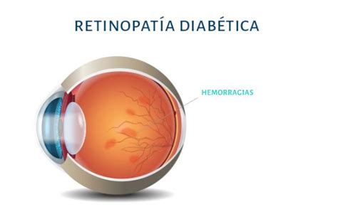 Retinopat A Diab Tica S Ntomas Y Tratamiento En Vigo