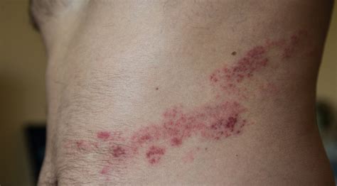 Herpes Zoster Preven O Sintomas E Tratamentos