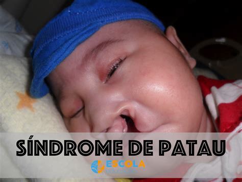 Síndrome de Patau o que é sintomas e características da doença