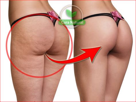 Acabar As Celulites Como Fazer Passo A Passo Receitas E Dicas