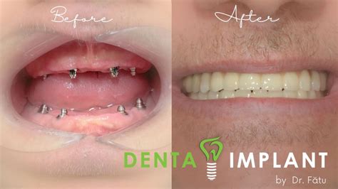 C T Cost Proteza Dentar Fix Dentaimplant