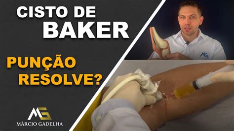 Cisto de baker tratamento punção e seus resultados YouTube