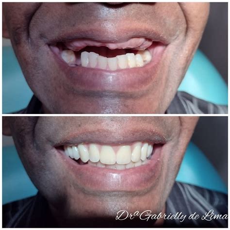 Sou apaixonada em antes e depois de próteses dentárias além de