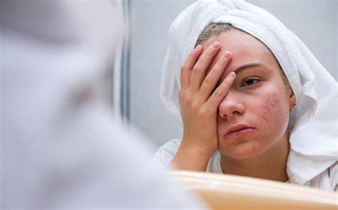 7 Powerful Techniques To Say Goodbye To Stubborn Acne Forever LifeBei