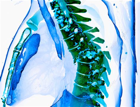 Thoracic Spine Fracture Ct Scan Stock Image C Science