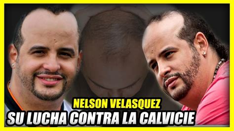 Historia De NELSON VELASQUEZ Su Lucha Contra La Calvicie YouTube