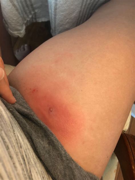 Pubic Ingrown Hair Cyst