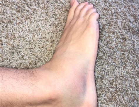 How To Quickly Heal A Sprained Ankle Artofit