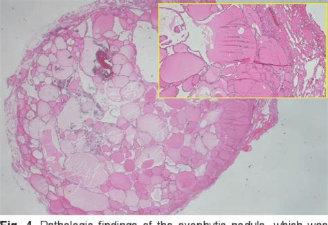 Figure 4 From A Case Of Lateral Ectopic Thyroid Mimicking The