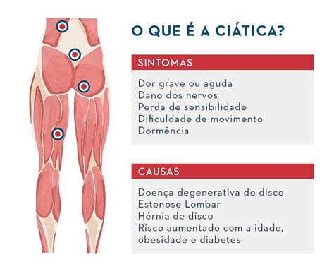 Saúde o que é ciática