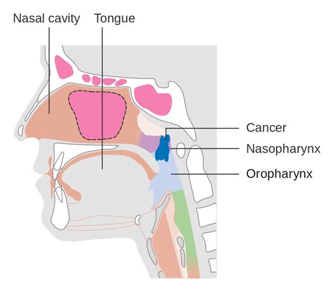 Signs And Symptoms Of Throat Cancer What Is Cancer