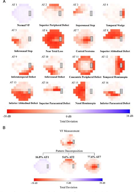 figure 1 from an artificial intelligence approach to detect visual field progression in glaucoma