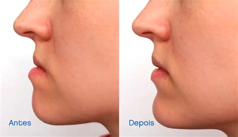 Cirurgia ortognática antes e depois da cirurgia maxilar