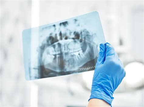 Cómo se ven las caries en una radiografía panorámica Lee
