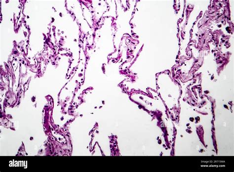Histopathology Of Lung Emphysema Light Micrograph Photo Under