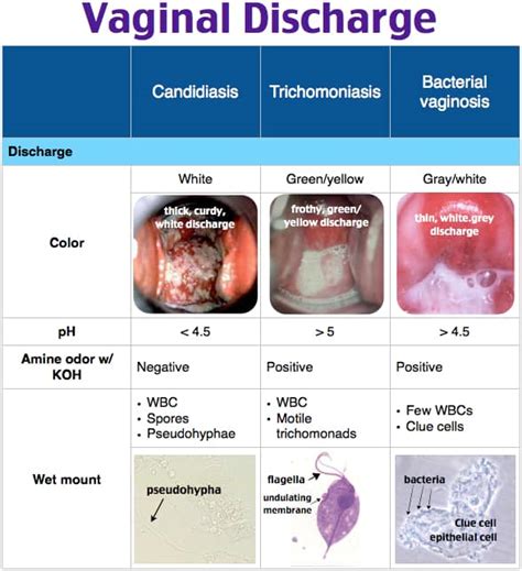 Candidiasis Discharge