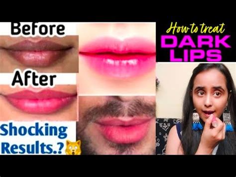 Effective Lip Serum For Dark Lips Dark Lips Causes Treatment Get
