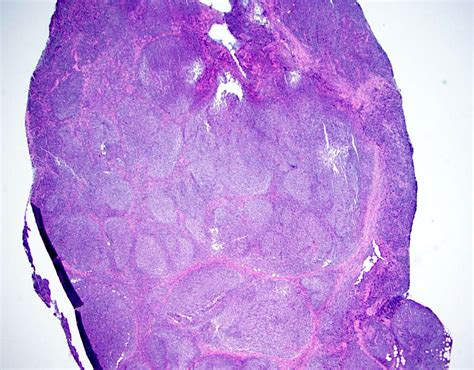 Pathology Outlines Follicular Usual