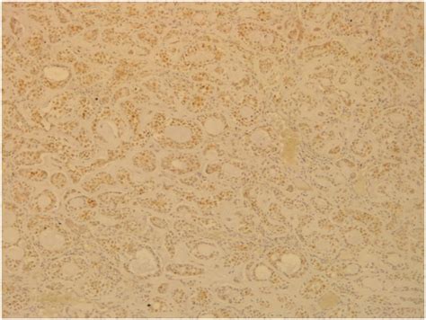 P Stain In Low Grade Acc Component Lymph Node Metastasis