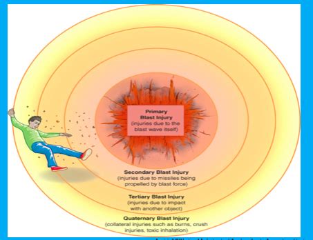 Trauma Overview Flashcards Quizlet