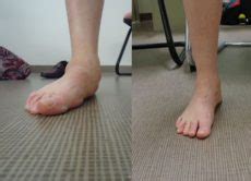 Adult Acquired Flatfoot Tibialis Posterior Tendon Dysfunction