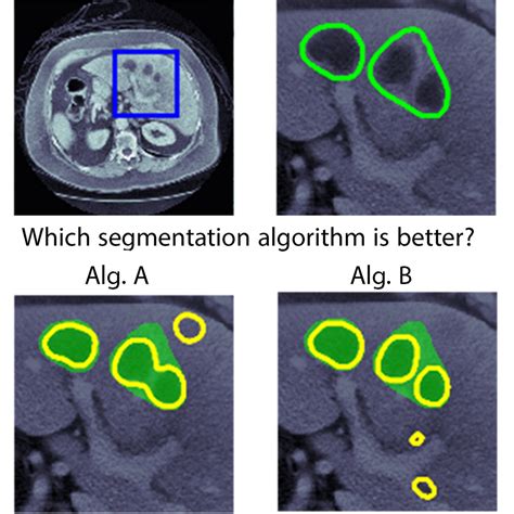 medical image segmentation evaluation kaggle