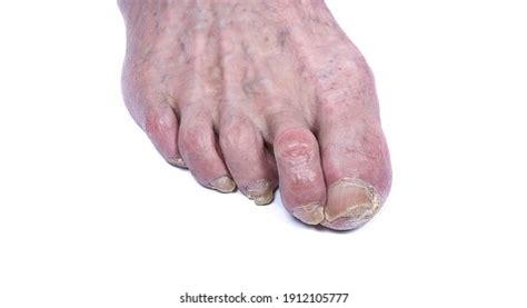 Nails Older Healthy Over 316 Royalty Free Licensable Stock Photos