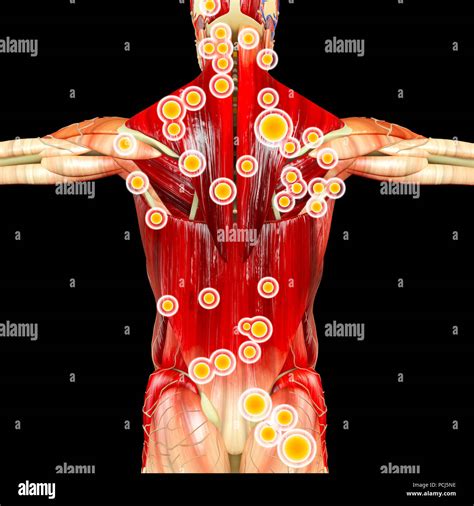 Magnético Alrededor malicioso puntos gatillo en el cuerpo humano