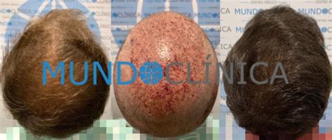 Implante Pelo Antes Y Despues Implante Capilar