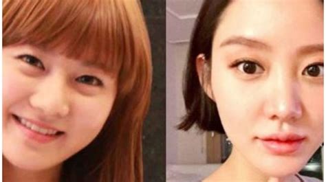 Artis Korea Yang Operasi Plastik Paling Banyak