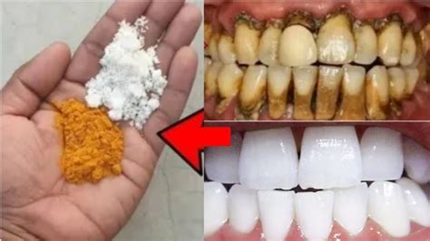 Blanchiment des dents en quelques secondes et nettoyage du tartre à la
