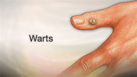 Out Of This World Info About How To Prevent Genital Warts From