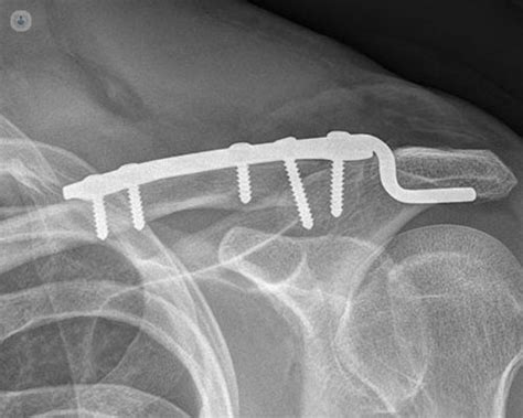 Osteosintesis Las Ventajas Que Ofrece Para Tratar Fracturas En Lima