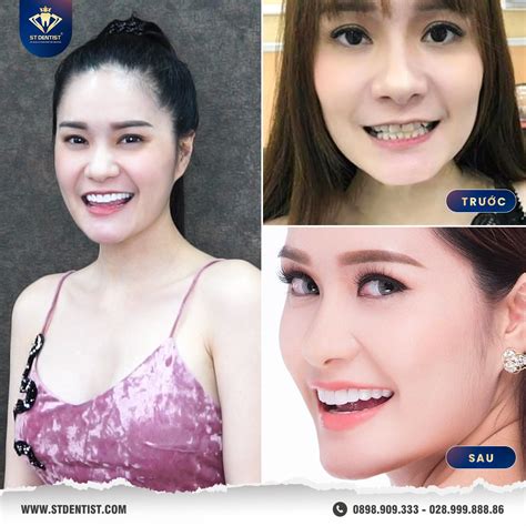 TRUNG TÂM NHA KHOA THẨM MỸ ST DENTIST Cạo vôi răng đánh bóng