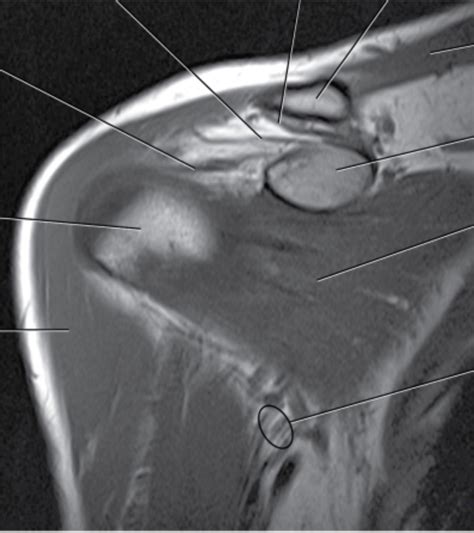 Mri Coronal Oblique Rt Shoulder Diagram Quizlet