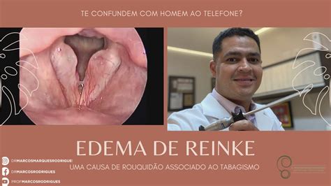 EDEMA DE REINKE YouTube