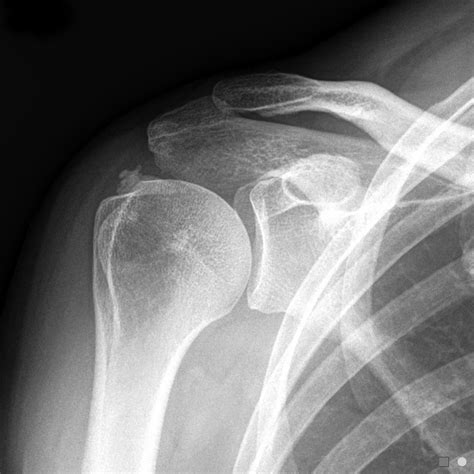 Plain Radiographic Evidence Of Stages Of Calcifying Tendinitis Of