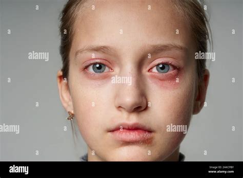 Allergic Reaction Skin Rash Close View Portrait Of A Girls Face Redness And Inflammation Of