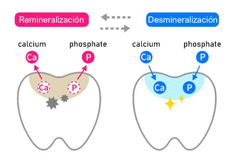 Hipomineralización Incisivo Molar Qué es y cómo se trata