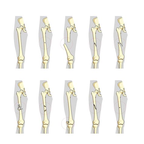 Understand Bone Fractures Causes Treatment Symptoms Zealmax