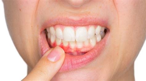 Qué es un absceso dental y cómo debe tratarse Mejor con Salud