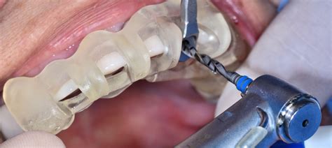Cirugía de implantes dentales guiada o no guiada Cuál es la mejor