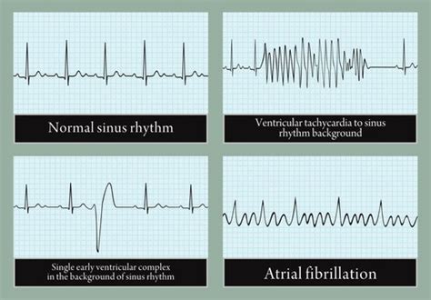 Normal Lead Ecg Labeled