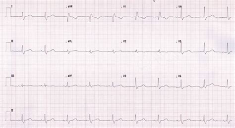 Dr Smith S ECG Blog A Wide Complex Tachycardia