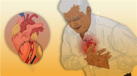 Cómo identificar un infarto en un adulto mayor Vida y Salud