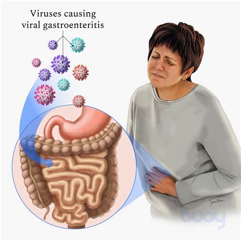 Symptoms Of The Stomach Bug In Adults